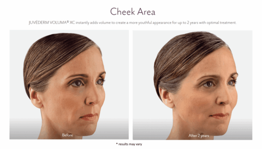 Juvederm Treatments - Shiloh Medical Clinic